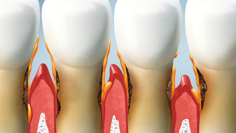 Gum Surgery in Coral Gables, FL | Gum Surgery Near Me